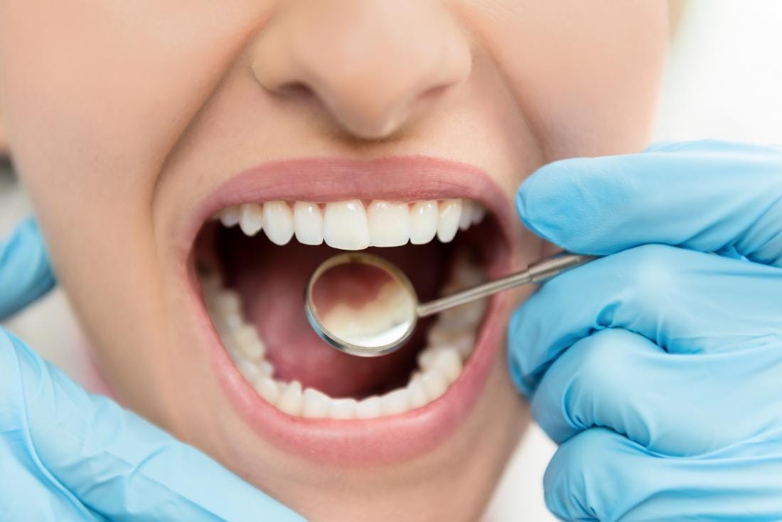 How to Get Rid of Cavities — Best Home Remedies | by Christina Scott ...
