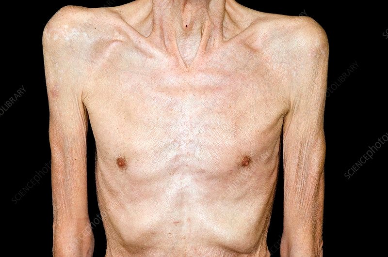 How To Weight Gain 10 Kg In 1 Month Docto Care Medium How To Weight Gain 10 Kg In 1 Month Docto Care Medium