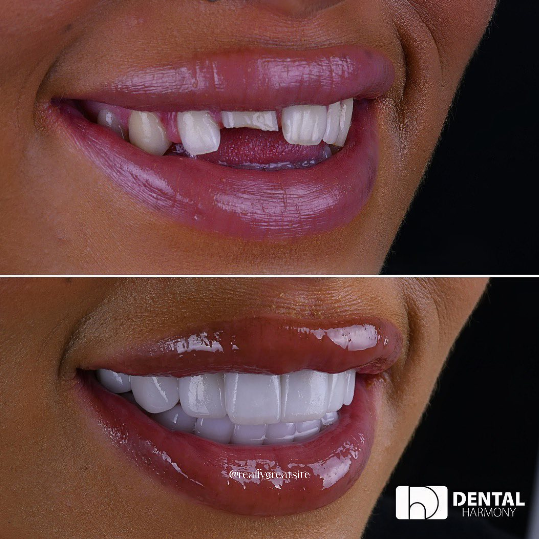 Non-invasive Dental Treatments - Dental Harmony Turkey - Medium