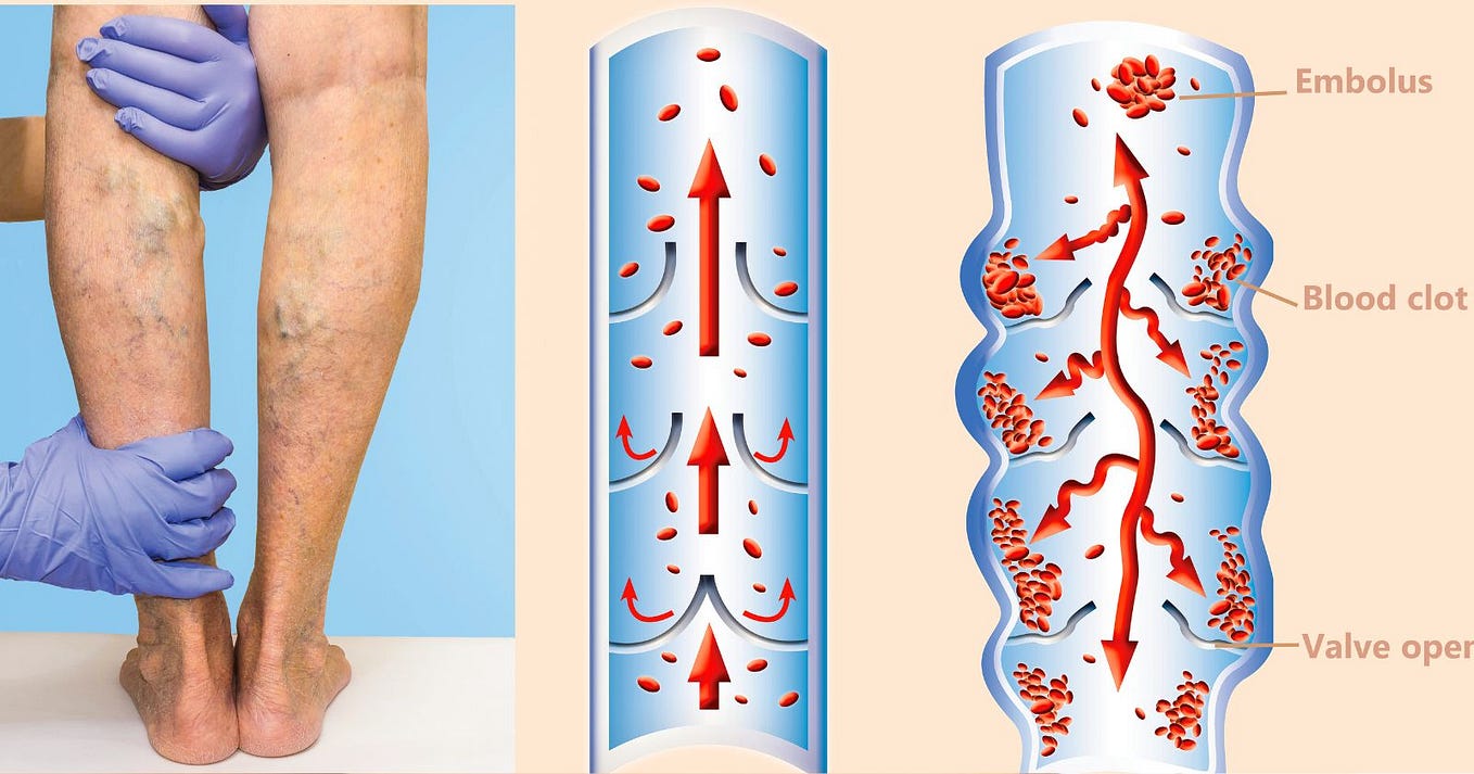 Trends in Vein Health: What You Need to Know | by Angelinabrad | Jul ...