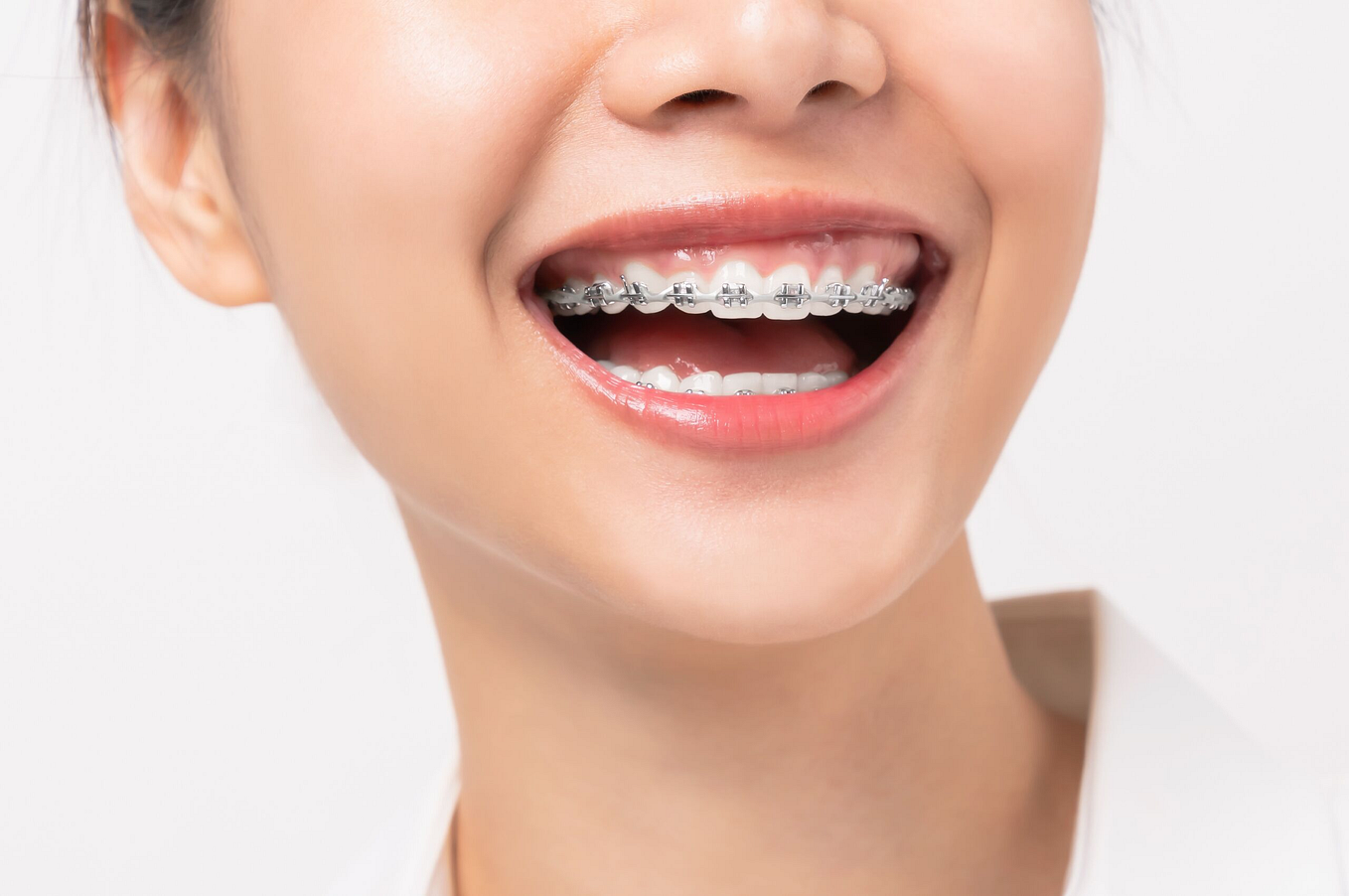 The Evolution of Braces: From Metal to Modern Solutions in Dubai | by ...