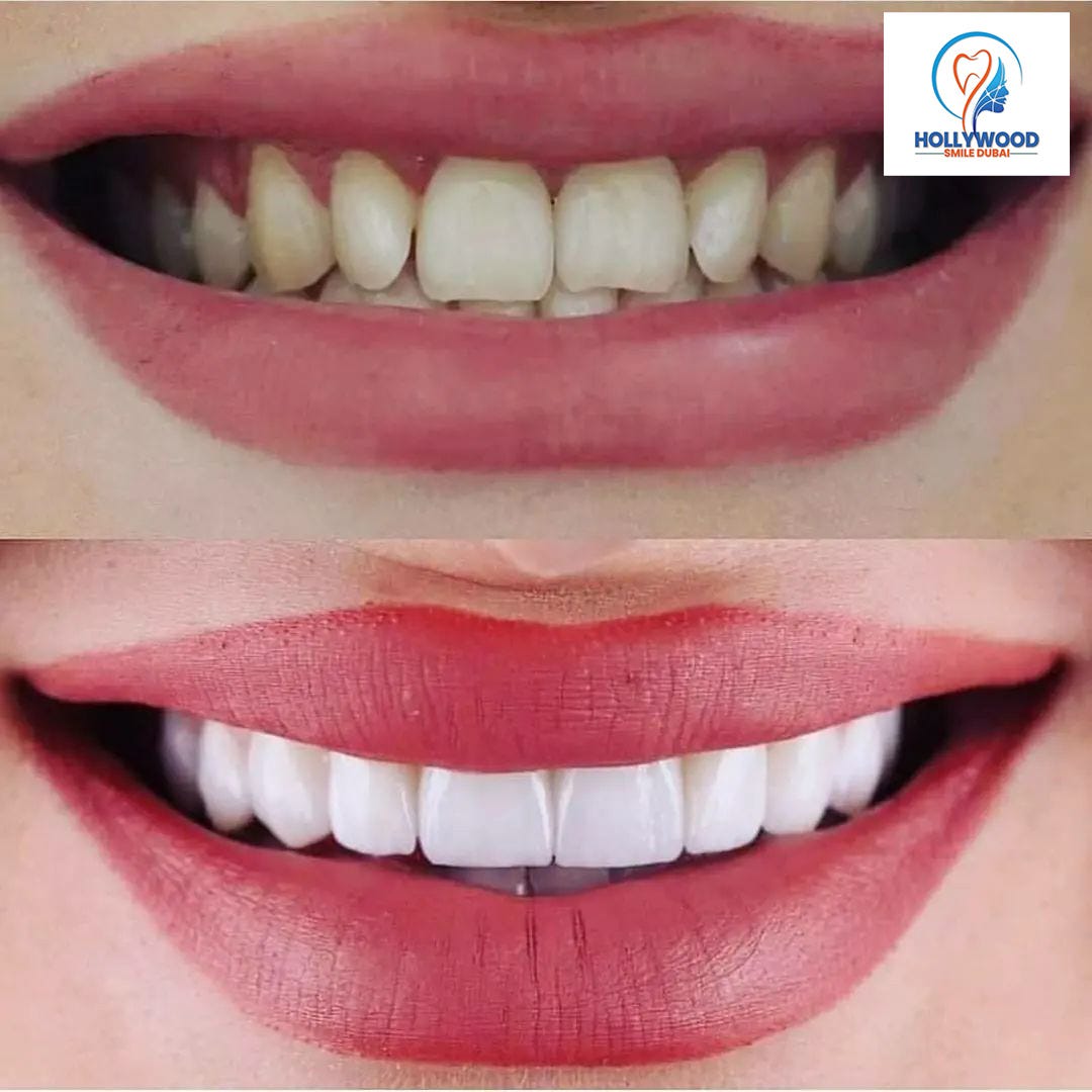 Hollywood Smile - Hollywood Smile - Medium