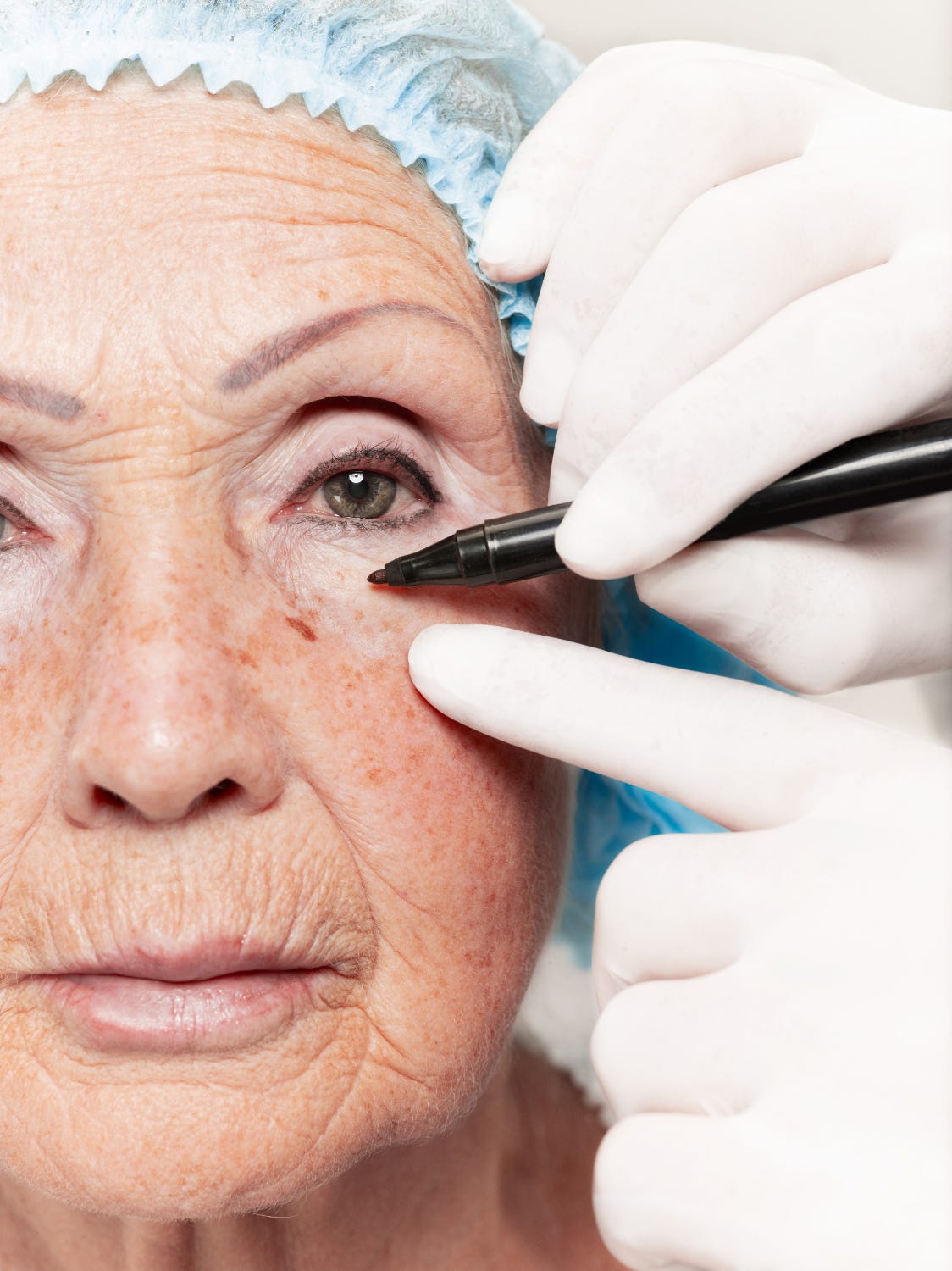 Smooth Away Wrinkles: Anti-Wrinkle Treatment in Melbourne - Aesthetic ...