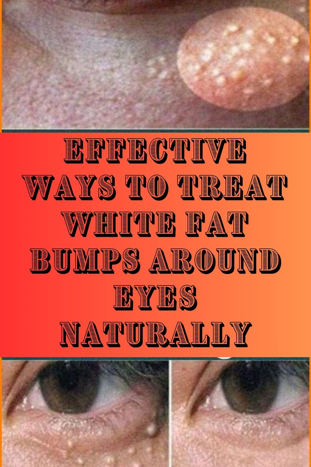How To Get Rid of White Fat Bumps Around Eyes Naturally - Victoriakeat ...