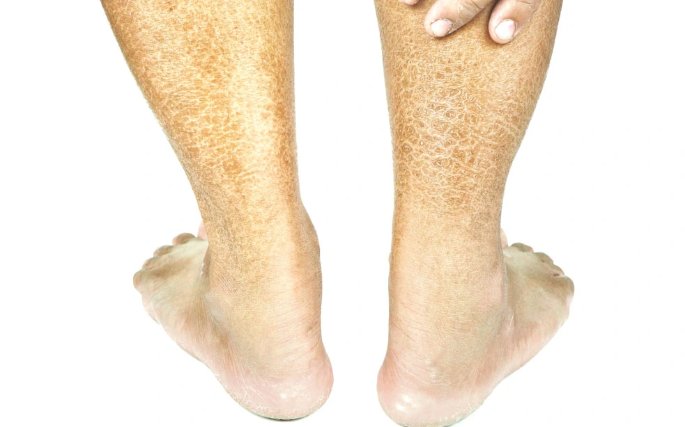 What is the best treatment for lamellar ichthyosis ...