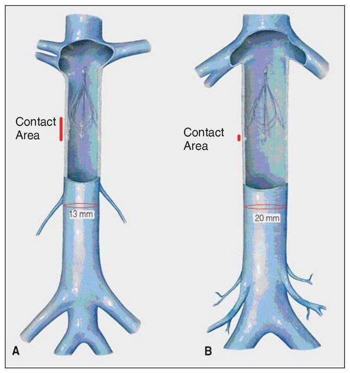 How do IVC Filters Function?. The inferior vena cava (IVC) is the… | by ...
