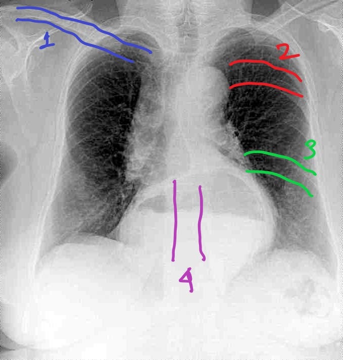 Lung Density On X Ray