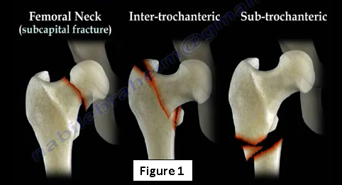 Sacral Sparing. Sacral sparing tests can be used to… | by Nabil ...
