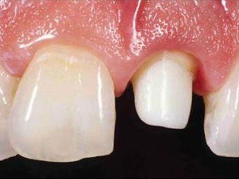 NIGHT GUARD (IMPAK) SOLUTION - VINCISMILE - Medium