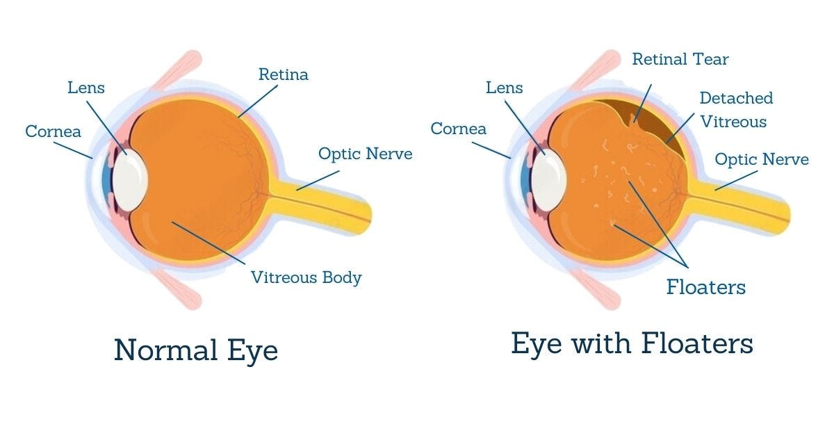 Macular Edema: Understanding, Treatment, and Prevention | Medium