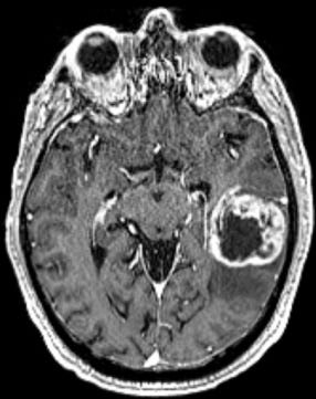 Glioblastoma Multiforme (GBM): An Overview | by Research Update | Aug ...
