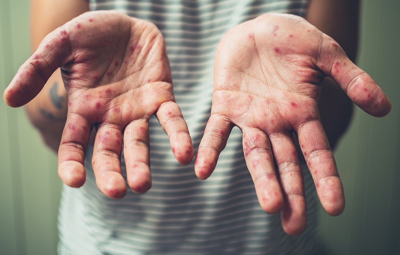 What is Rabies?. Rabies is a contagious infection… | by Nediir? | Medium