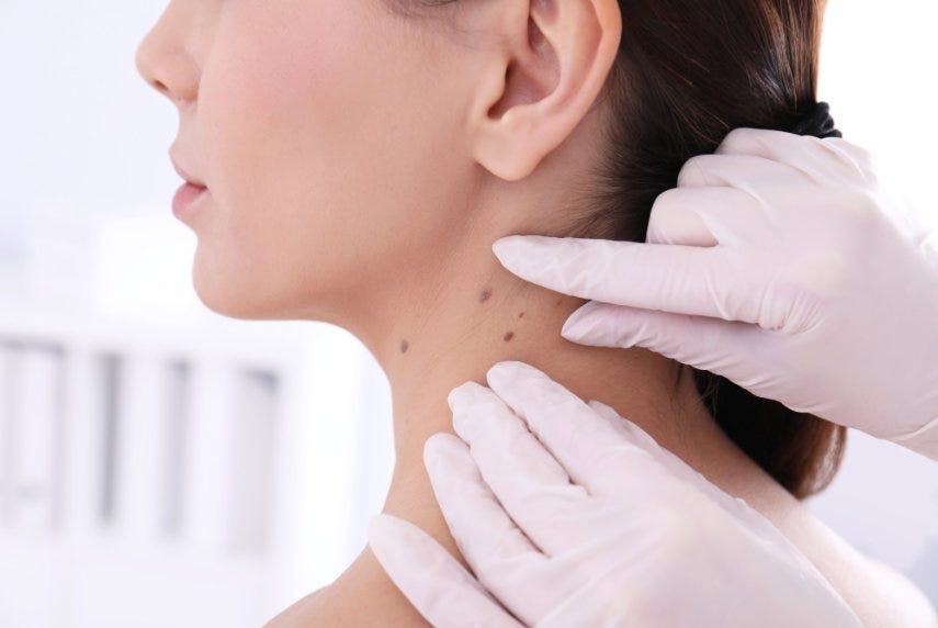 The Silent Killer: Signs Total Body Mapping Could Catch - Florida Skin ...