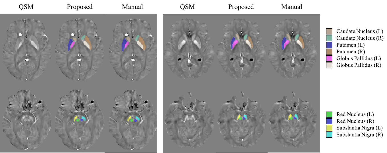 Deep Gray Matter (DGM) Segmentation using 3D Convolutional Neural Network: application to QSM ...