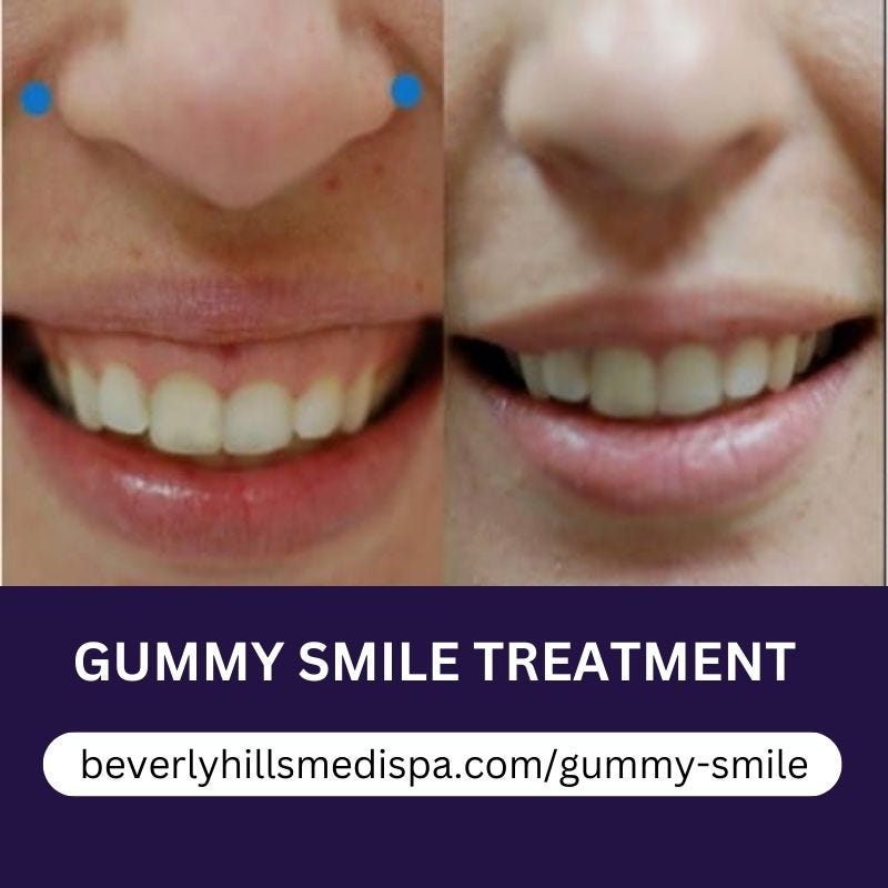 Gummy Smile Botox Treatment - Beverly Hills Wellness Center - Medium