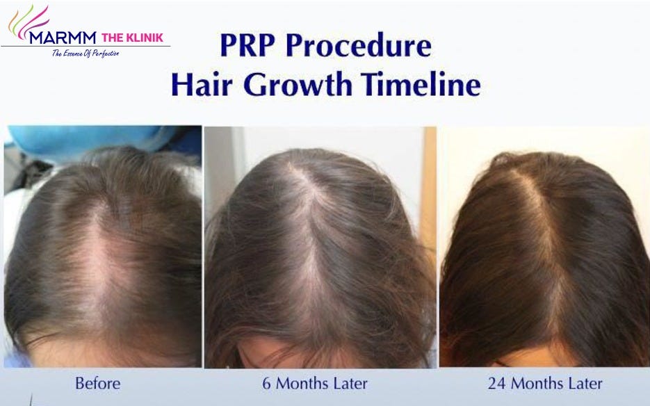 Receding Hairline? What can be your Treatment Options? | by Marmm ...