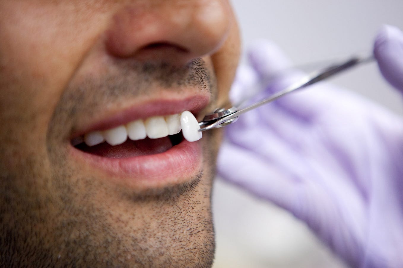 Understanding Cosmetic Fillings. Dental Cosmetic fillings can make it ...