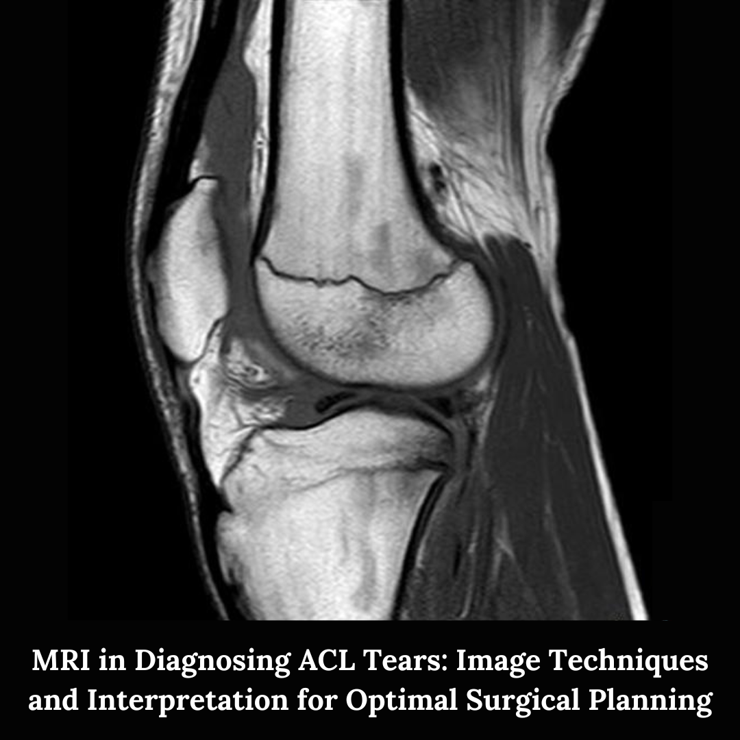 Return To Play Rtp Protocols And Outcomes Measurement After Acl Reconstruction With Pristyn