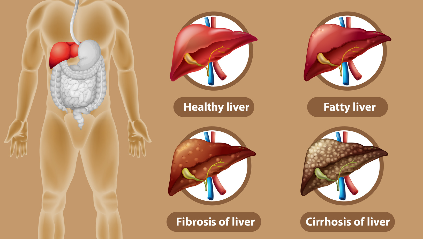 Understanding the Stages of Liver Disease — Useful Information by ...