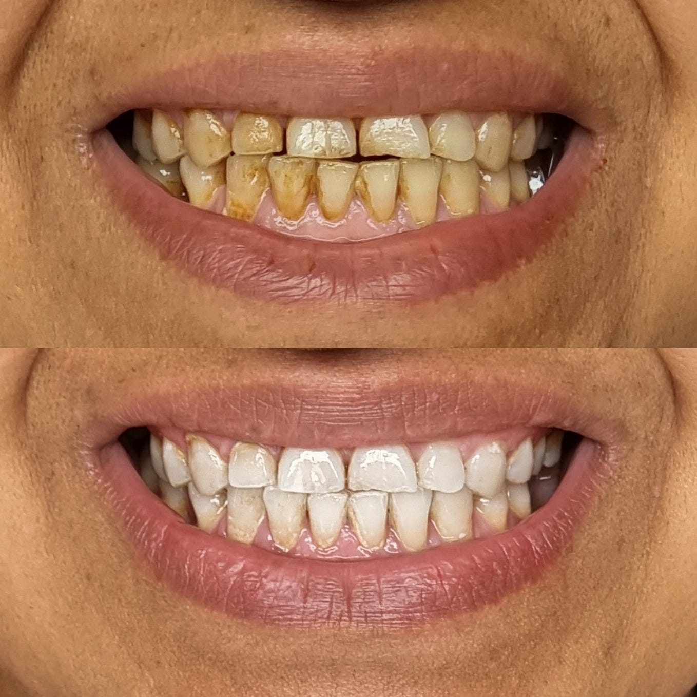 Teeth Whitening Melbourne - Teeth Whitening Melbourne - Medium