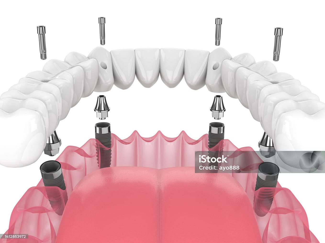 Pearl Dental Clinics in Dubai offers outstanding dental implants for ...