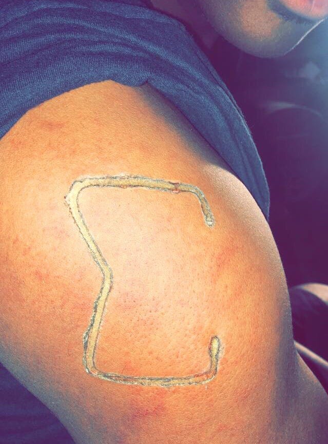 The Story Behind the Scar. Choosing to brand at college… | by Alisia ...