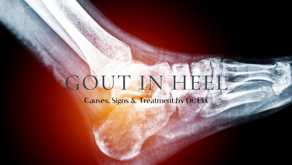 Gout in Shoulder: Causes, Symptoms and Treatment | by Dr. Elix | Medium