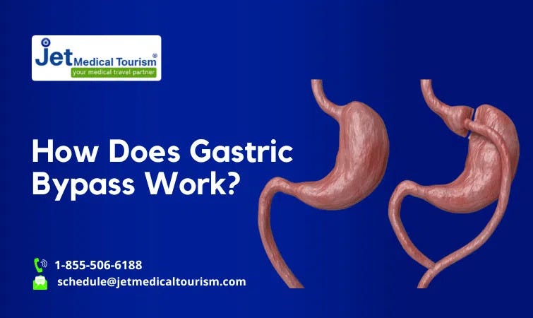 How Does Gastric Bypass Work? - Jetmedicaltourism Com - Medium