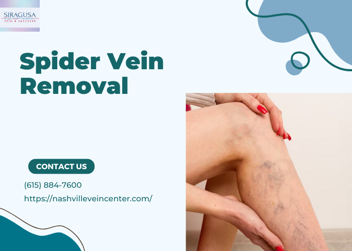 Venous Insufficiency - Siragusa Vein and Laser Center - Medium