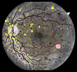 Intelligent Edge: Building a Skin Cancer Prediction Application using Azure Machine Learning ...