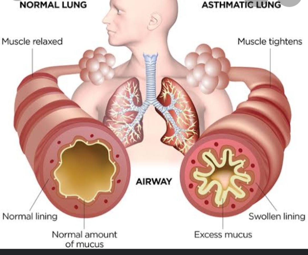 DRUG INDUCED PULMONARY DISEASES ASTHMA AND BRONCHOSPASM Asthma is a ...