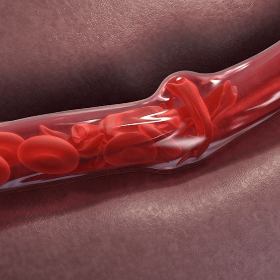 BREAKING HEARTS AND BARRIERS: The Untold Love Struggles of Sickle Cell ...