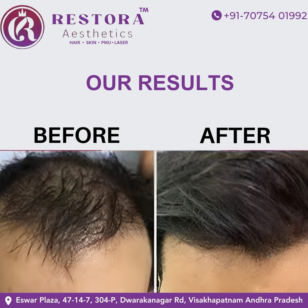 Best Hair Transplant in vizag - Restora Aesthetics - Medium