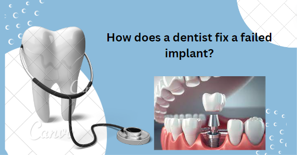 https://zillynews.com/how-does-a-dentist-fix-a-failed-implant ...