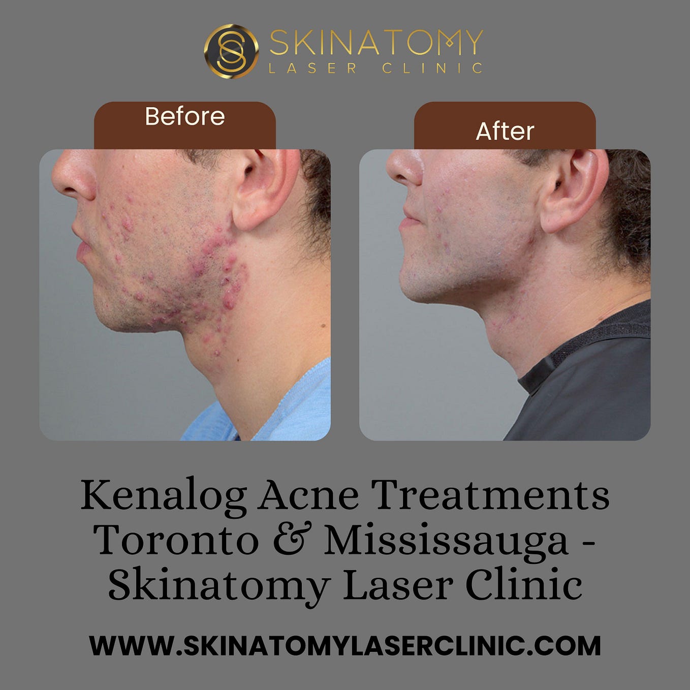 Lipolysis (Fat Dissolving Injections) Toronto & Mississauga ...