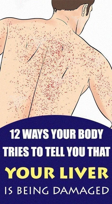 How to Get Rid of Varicose Veins Naturally - Joel Parris - Medium