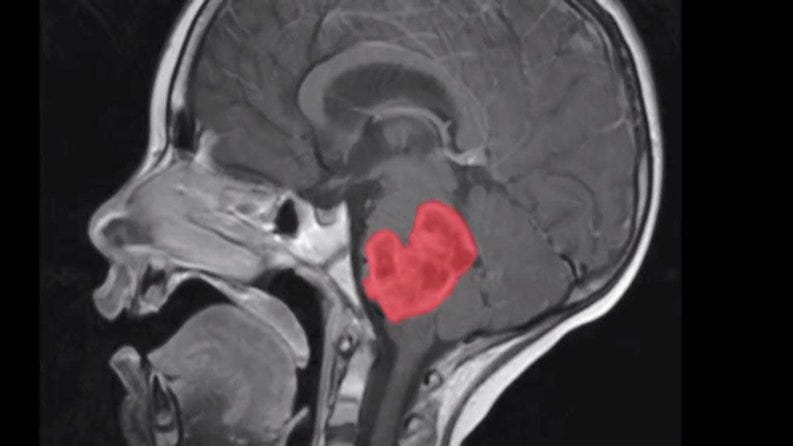 Shedding Light on Neuroblastoma: Understanding, Treatment, and Hope | by Research Update | May ...