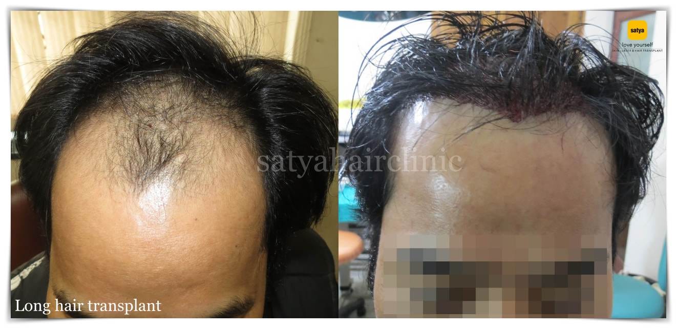 Unlocking Confidence: The Journey of Hair Transplant in Delhi | by ...