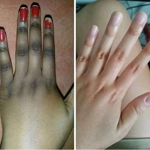 Skin Lightening 0717686664 injection hips/bums in Pretoria,Johannesburg ...
