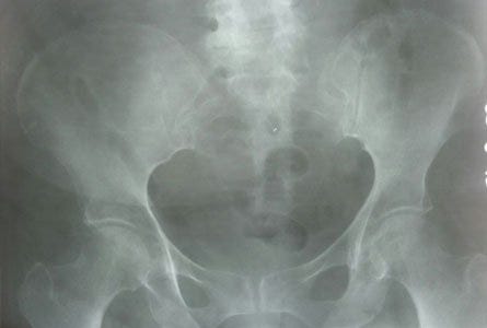 Knee Replacement Surgery: Your Complete Guide | by Joint Jaipur | Apr ...