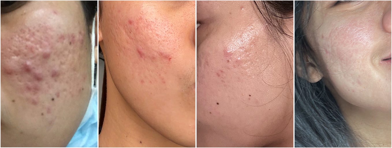 Acne scar treatment korean skincare | by Chrissy Luxury Haven | May ...