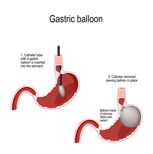 Spatz Dubai: Revolutionizing Weight Loss with the Adjustable Gastric ...