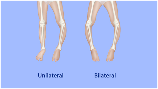 lumbar scoliosis treatment in India | by Childorthospinecare | Jun ...