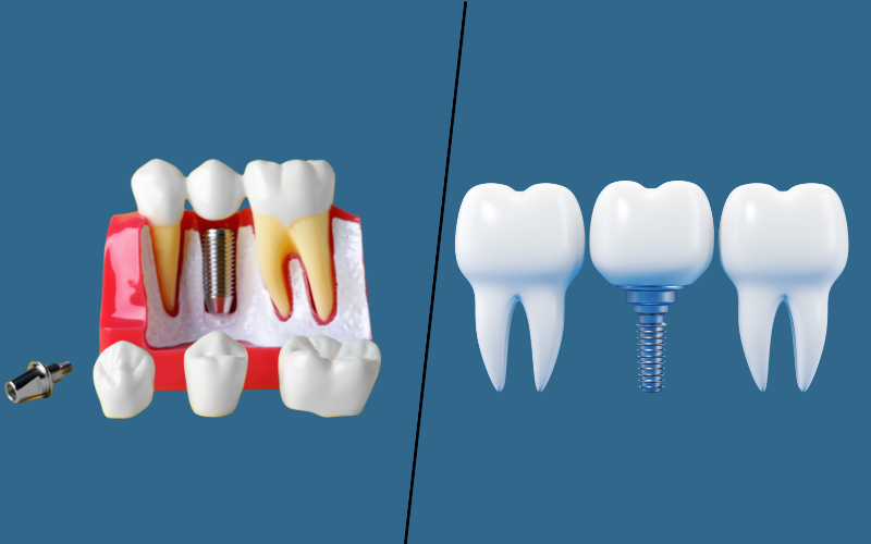 Ultimate Guide To Dental Implants: Your Path To A Renewed Smile | by ...