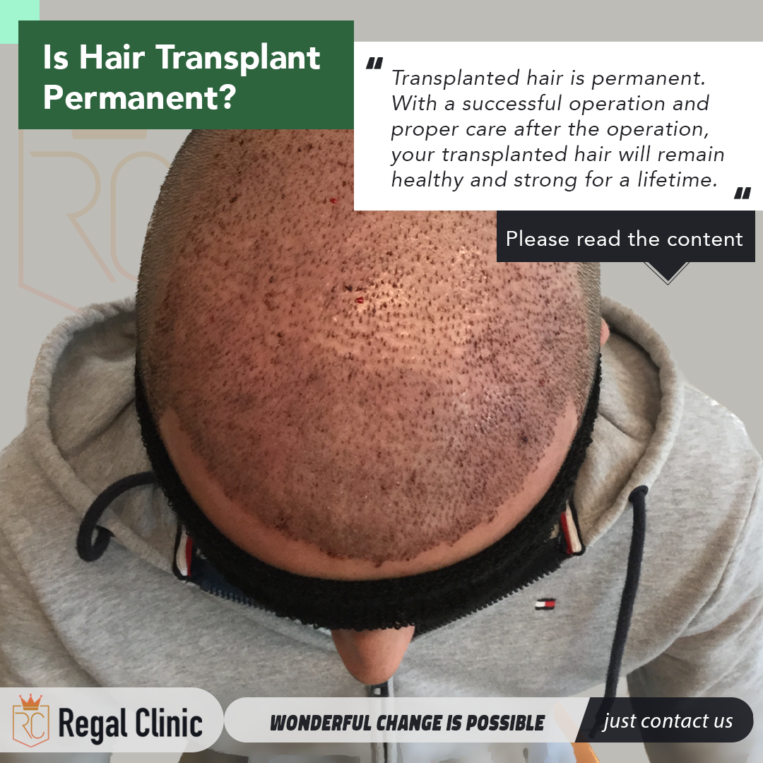 The FUE Hair Transplant. Healthy hair follicles taken from the… | by ...