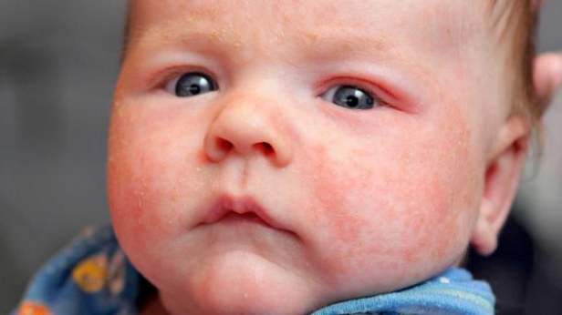 Excessive Sweating in Babies: Causes and Treatments | by Baby Care | Medium