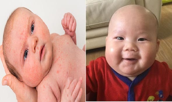 A Case of Congenital Zosteriform Nevus Spilus and Hypopigmented Mycosis ...