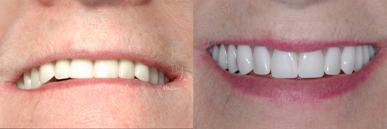 The Complete Guide to Full Dental Implants | by Dr. Devi | Medium