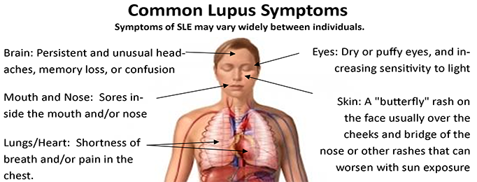 Can Men Have Lupus