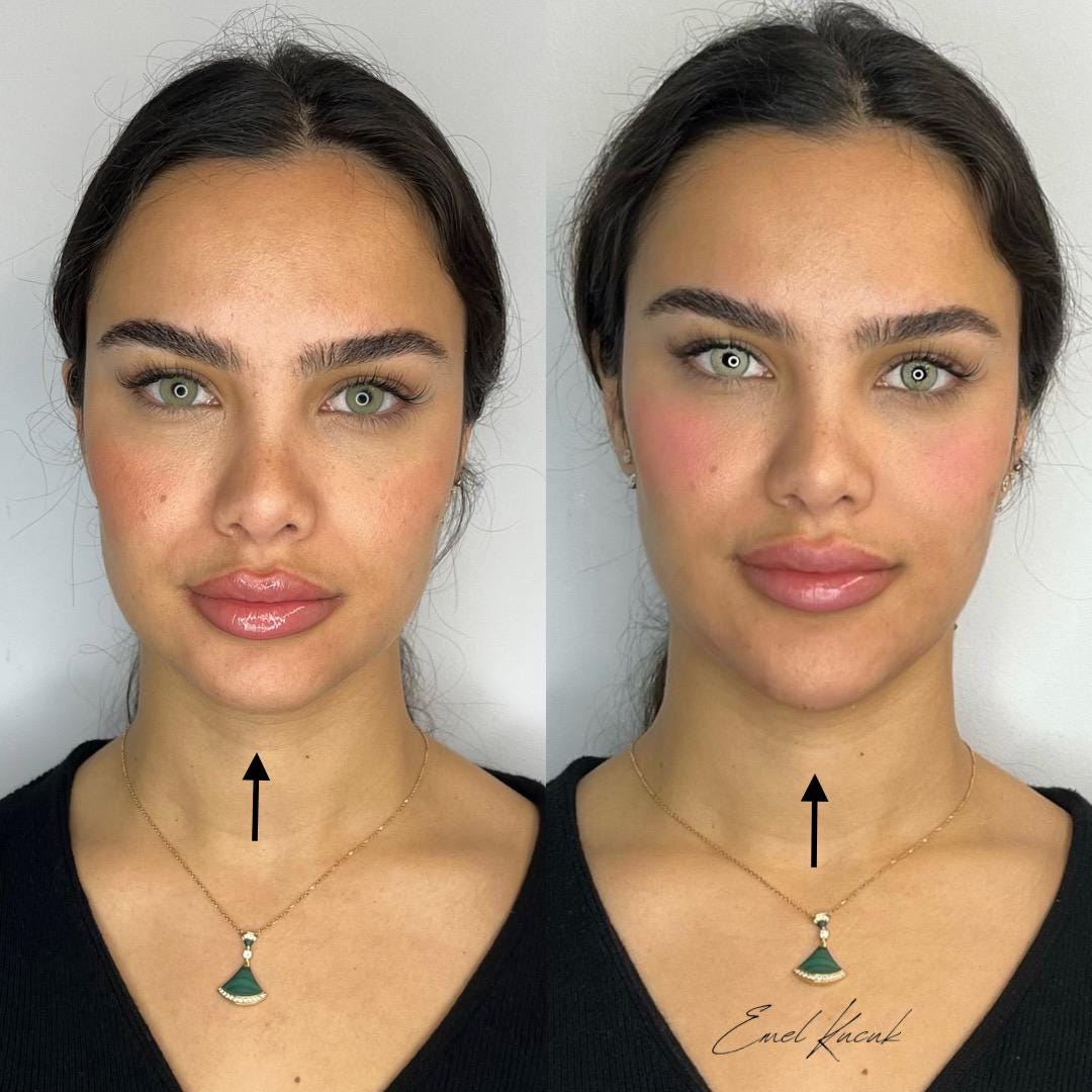 Dermal Fillers Cost Analysis in Qatar & Doha: What You Need to Know ...